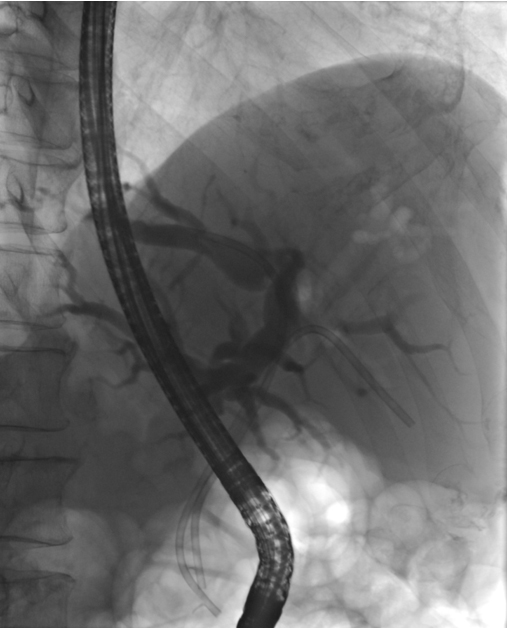 Strategy for ERCP stenting in cholangiocarcinoma