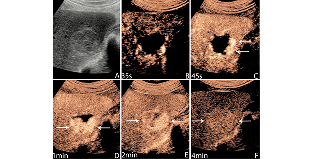 Topic: Advancement of Imaging Diagnosis of Liver Cancer