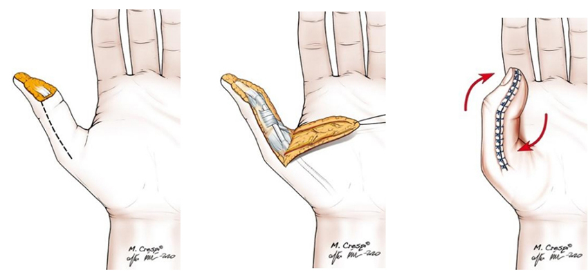 Management of soft tissue defects of the thumb