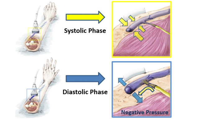 Topic: Recent Advances in Microsurgery for Lymphedema