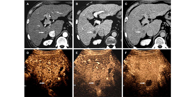 Topic: Advancement of Imaging Diagnosis of Liver Cancer