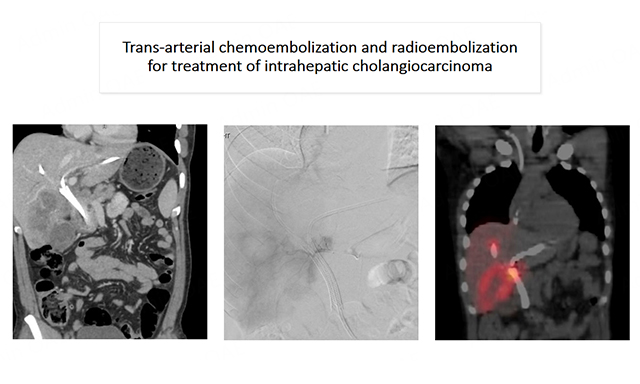 Topic: Challenges and Opportunities for Treating Intrahepatic Cholangiocarcinoma