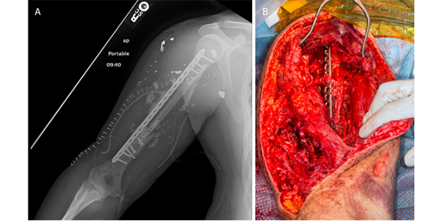 Topic: Advances in Microsurgery for Upper and Lower Extremity ...