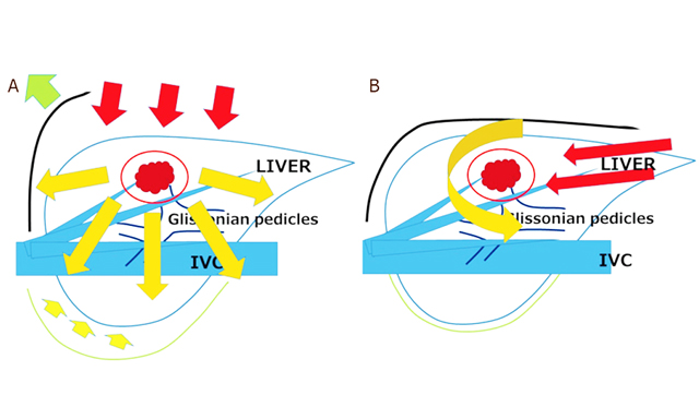Topic: Minimally Invasive Surgery for HCC