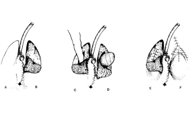 Mini-invasive Surgery(MIS) - OAE Publishing Inc.