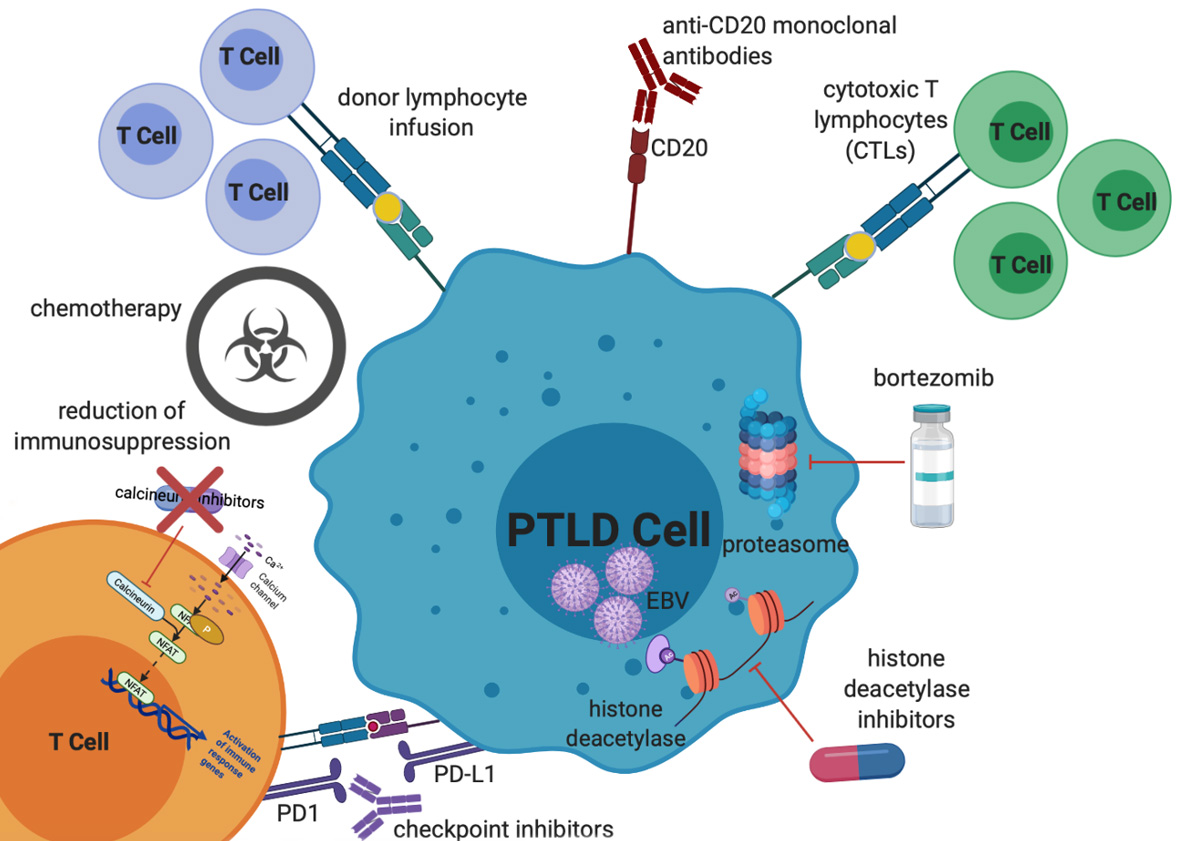 Epstein Barr Virus associated Post transplant Lymphoproliferative epstein-barr-virus-associated-post-transplant-lymphoproliferative