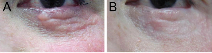 Laser Resurfacing for the Management of Periorbital Scarring