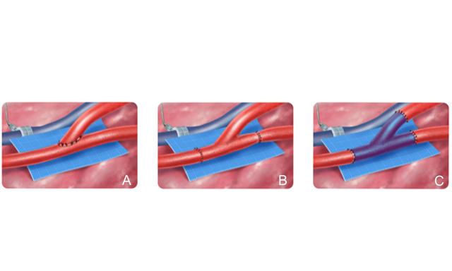 Topic: Soft Tissue Reconstruction of Traumatic Lower Extremity Injuries