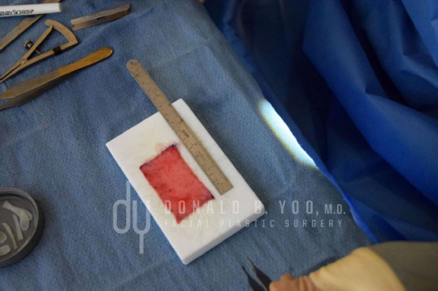 An updated diced cartilage fascia technique for dorsal augmentation in ...