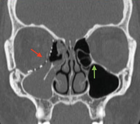 Operative technique for a combined transcaruncular-transconjunctival ...