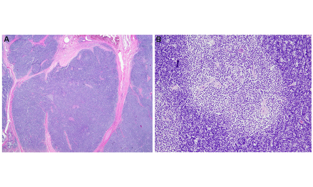 Topic: The Pathology of Thymic Epithelial Tumors